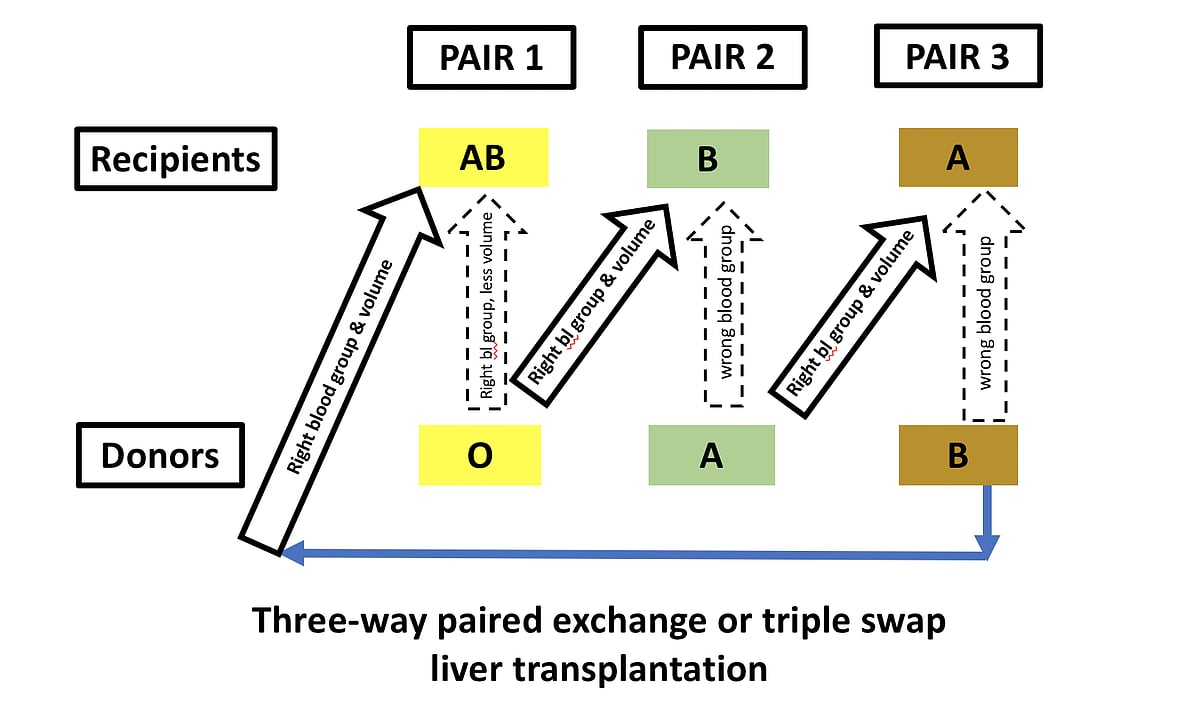 India’s First Three-way Swap Liver Transplant Chain At Medanta Saves ...