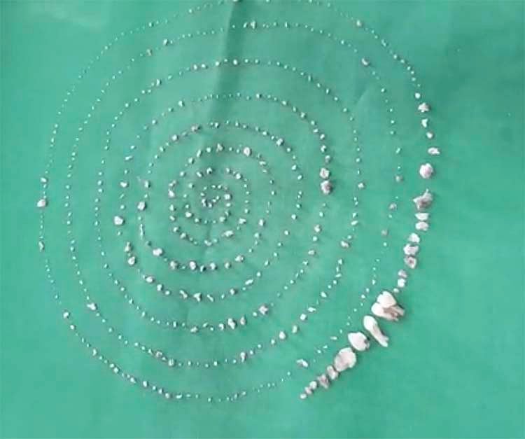 In rare surgery, Chennai doctors extract 526 teeth from 7-year-old's mouth