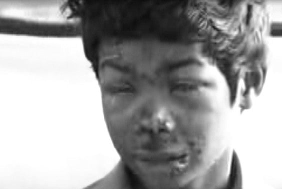 Nine-year-old Chennai boy suffers severe burns as mobile on charge explodes