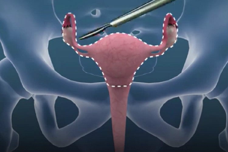 Video: Female-to-male sex reassignment surgery explained