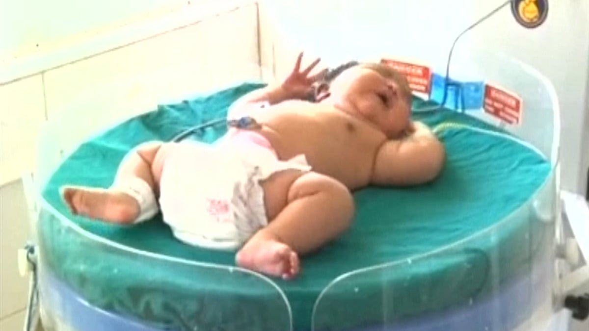 India’s ‘Heaviest Baby’ Weighing 6.8 kg Born To Karnataka Woman