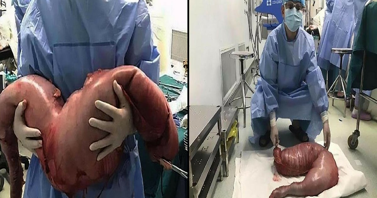 22 Yrs Of Constipation: 13 Kg of ‘Poop’ Surgically Removed