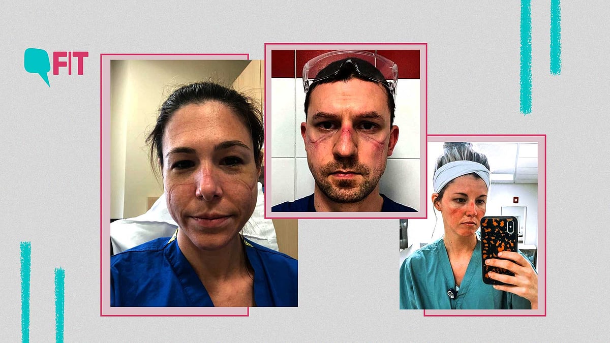 Rash, Sweat, Bruises: Wearing PPE for Hours Causing Skin Infection