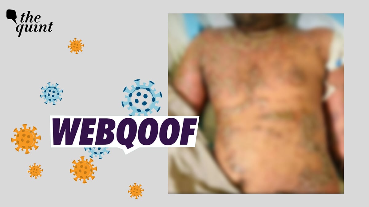 Fact-Check | Unrelated Images Shared as Human With Lumpy Skin Disease