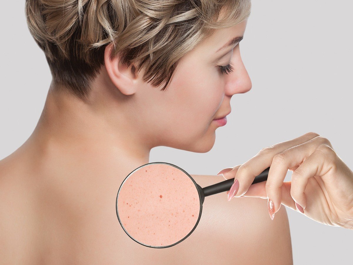 Fungal Infection Prevention: Tips To Prevent & Control Fungal Infection