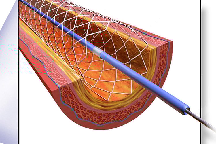Stent cap revision: Stakeholders to meet govt pharma body on Feb 5