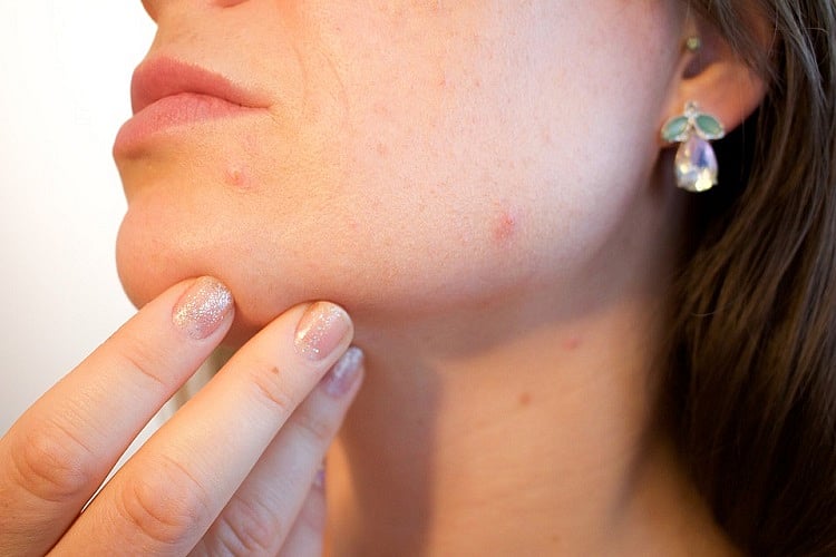 Health Check: is it bad to pop your pimples?
