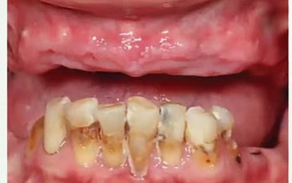 7 of 10 Pinoys suffer from dental caries