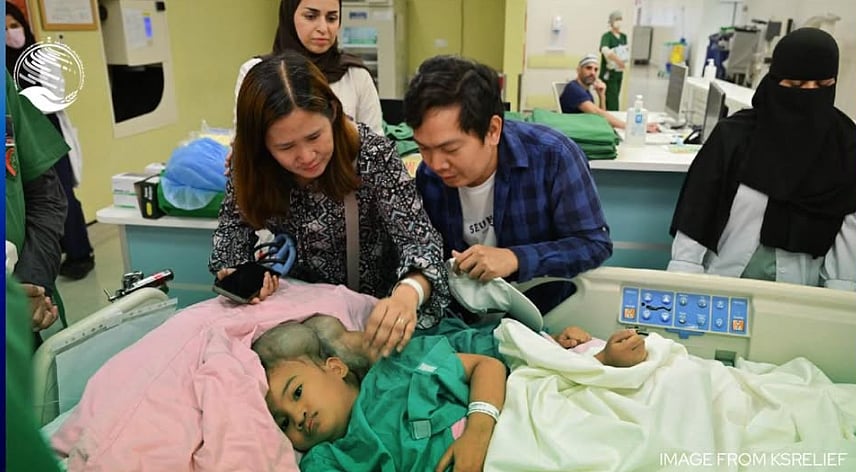 Filipino Conjoined Twins Successfully Separated in Complex 13-Hour ...
