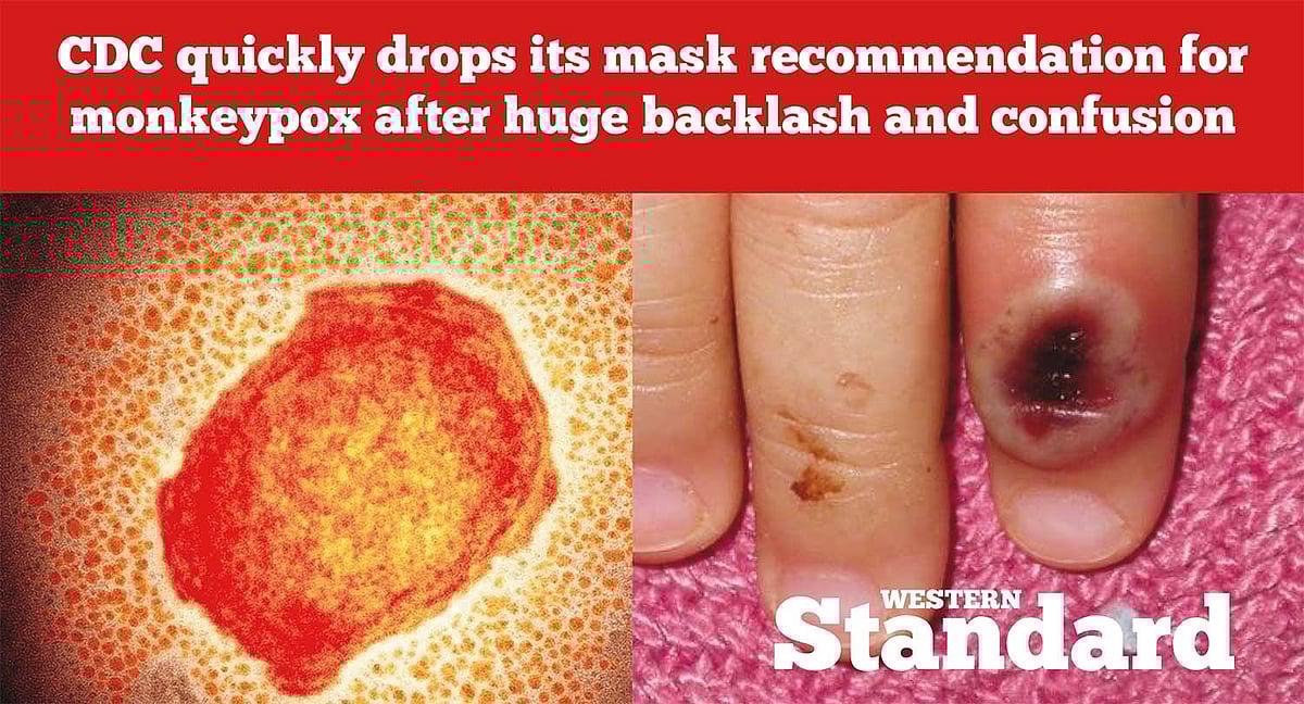 CDC quickly drops monkeypox mask recommendation after huge backlash